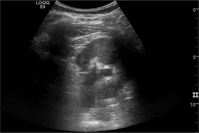 Distal VUJ stone: Case 2 • LITFL • Ultrasound Clinical Cases