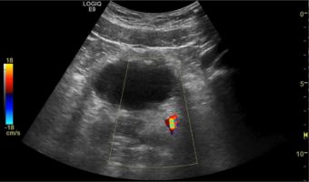 Distal VUJ stone: Case 2 • LITFL • Ultrasound Clinical Cases