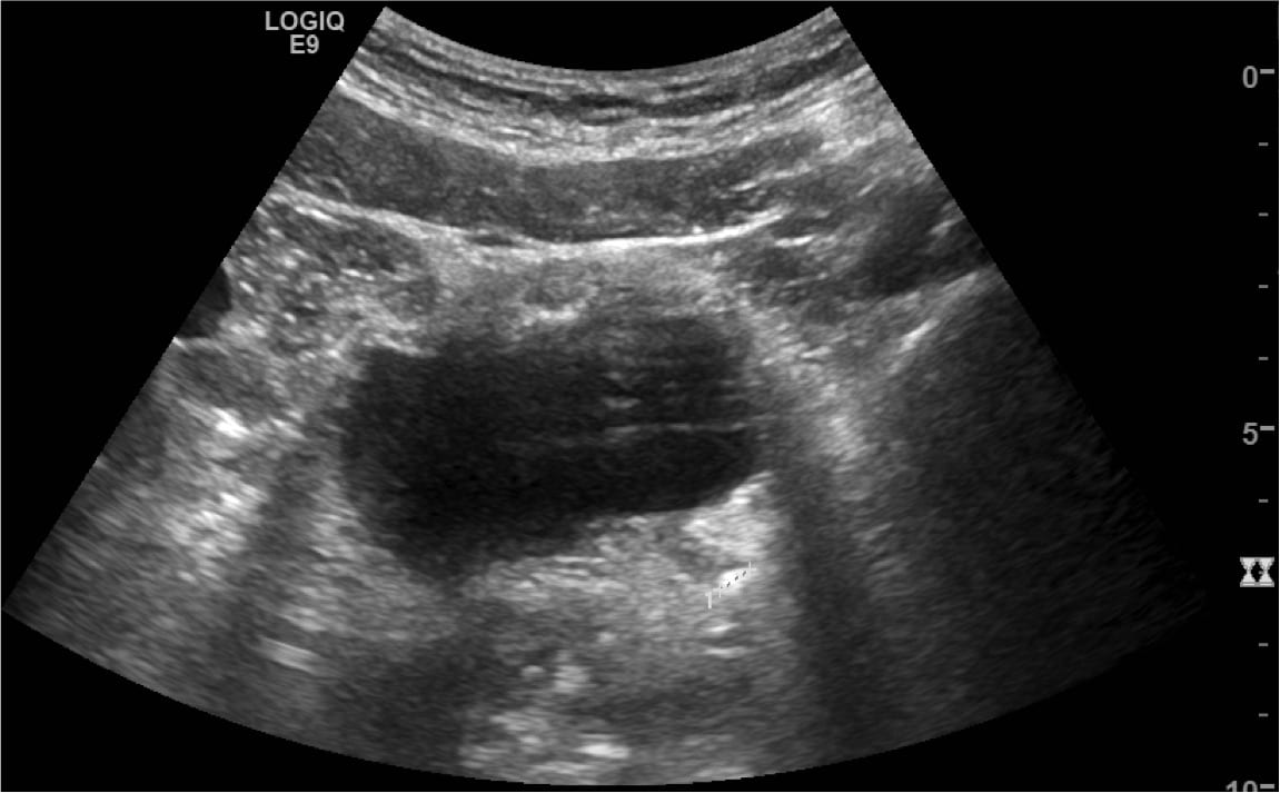 Distal VUJ stone: Case 2 • LITFL • Ultrasound Clinical Cases