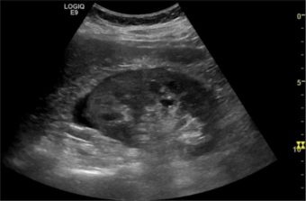 Distal VUJ stone: Case 3 • LITFL • Ultrasound Clinical Cases