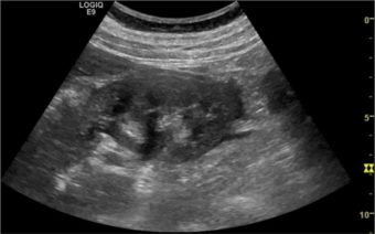 Distal VUJ stone: Case 3 • LITFL • Ultrasound Clinical Cases