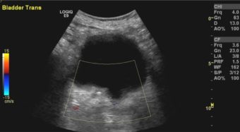 Distal VUJ stone: Case 3 • LITFL • Ultrasound Clinical Cases