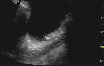 Distal VUJ stone: Case 3 • LITFL • Ultrasound Clinical Cases