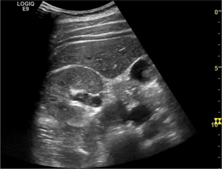 Distal VUJ stone: Case 4 • LITFL • Ultrasound Clinical Cases