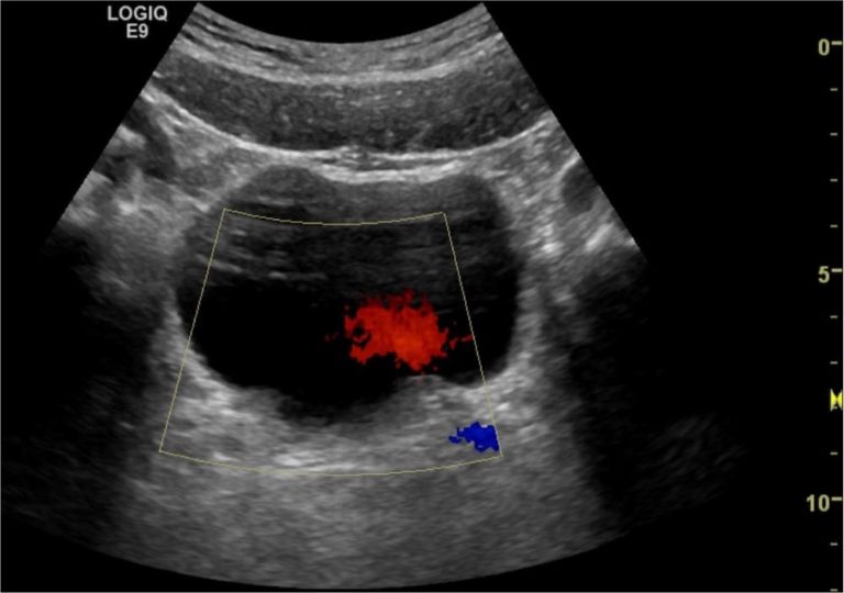 Distal VUJ stone: Case 4 • LITFL • Ultrasound Clinical Cases