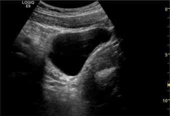 Distal VUJ stone: Case 4 • LITFL • Ultrasound Clinical Cases