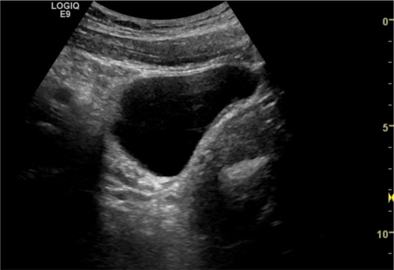Distal VUJ stone: Case 4 • LITFL • Ultrasound Clinical Cases