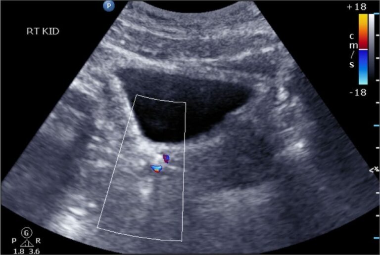 Distal VUJ stone: Case 5 • LITFL • Ultrasound Clinical Cases