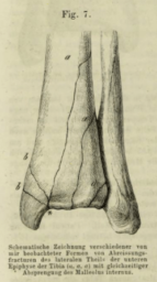 Richard von Volkmann • LITFL • Medical Eponym Library