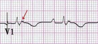 Killer ECG Patterns: Part 1 • LITFL • ECG Library