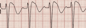 Killer ECG Patterns • LITFL Medical blog • ECG Library