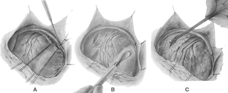 Claude Beck • LITFL • Medical Eponym Library