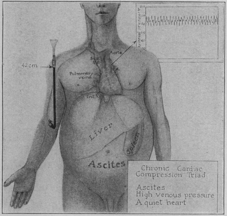Claude Beck • LITFL • Medical Eponym Library