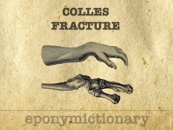 Colles fracture Archives • LITFL
