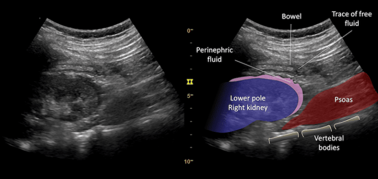 Ultrasound Case 093 • LITFL • POCUS Self-Assessment Quiz