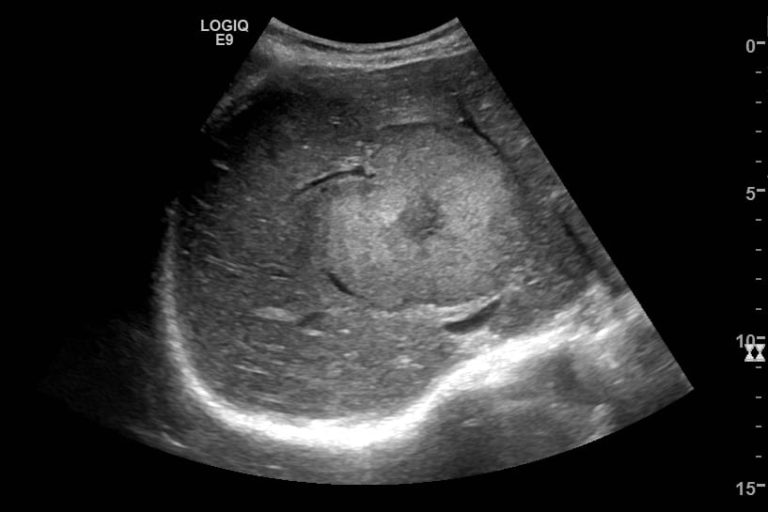 Ultrasound Case 051 • LITFL • POCUS Self-Assessment Quiz