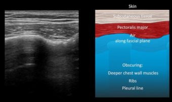 Ultrasound Case 066 • LITFL • POCUS Self-Assessment Quiz