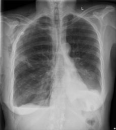 Lung collapse Case 1 • LITFL • Ultrasound library clinical case