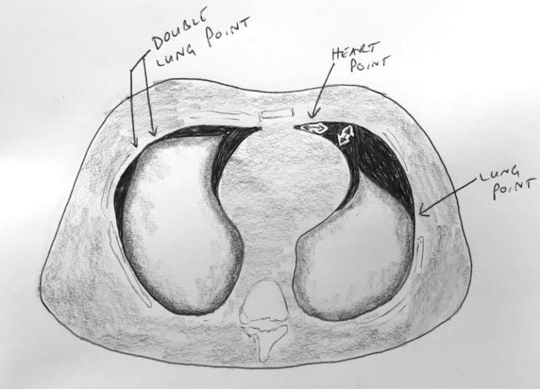Pneumothorax Case 5 • LITFL • Ultrasound library clinical case
