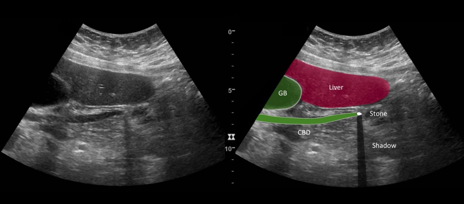 Ultrasound Case 078 • LITFL • POCUS Self-Assessment Quiz