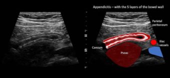 Ultrasound Case 083 • LITFL • POCUS Self-Assessment Quiz