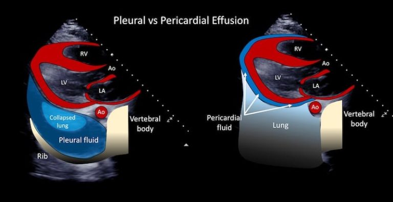 Ultrasound Case 094 • LITFL • POCUS Self-Assessment Quiz