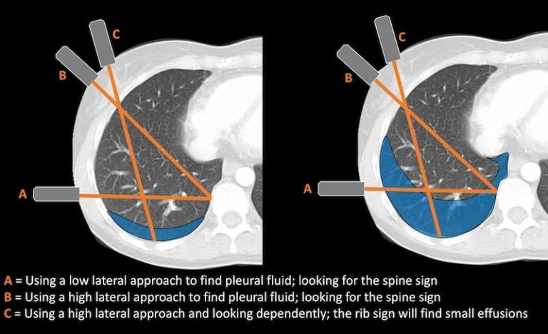 Ultrasound Case 094 • LITFL • POCUS Self-Assessment Quiz