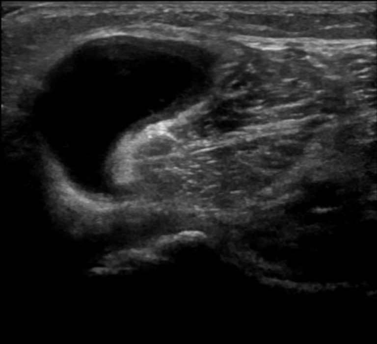 Ultrasound Case 098 • LITFL • POCUS Self-Assessment Quiz