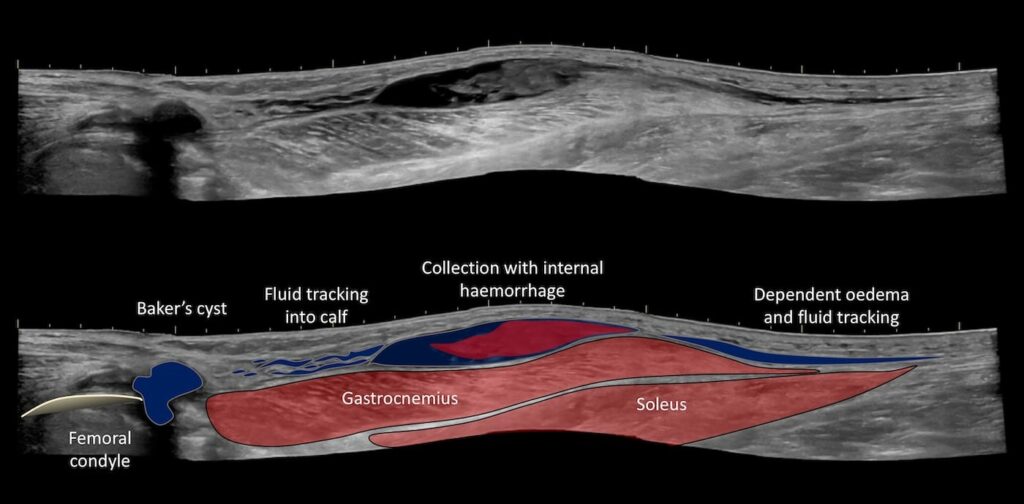 Ultrasound Case 098 • LITFL • POCUS Self-Assessment Quiz