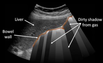 Ultrasound Case 089 • LITFL • POCUS Self-Assessment Quiz