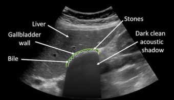 Ultrasound Case 089 • LITFL • POCUS Self-Assessment Quiz