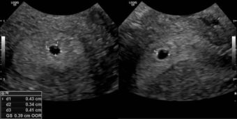 Ultrasound Case 090 • LITFL • POCUS Self-Assessment Quiz