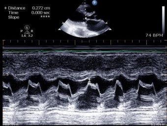 Ultrasound Case 091 • LITFL • POCUS Self-Assessment Quiz