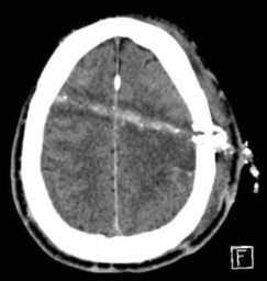 Bullet in the Head • LITFL • Neurological Mind-Boggler