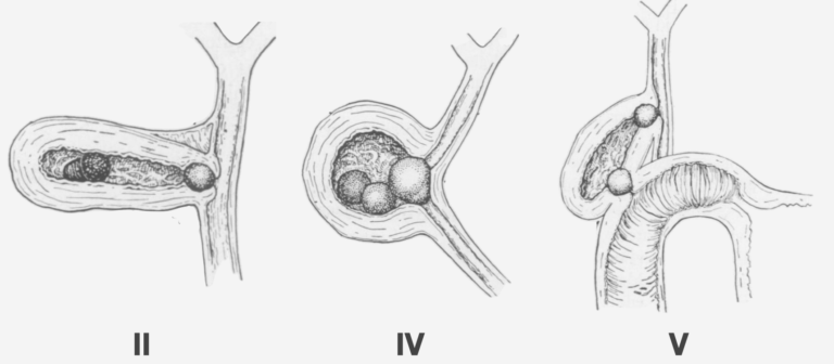 Mirizzi syndrome • LITFL Medical Blog • Medical Eponym Library
