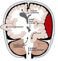 Brain Herniation • LITFL • CCC Neurology
