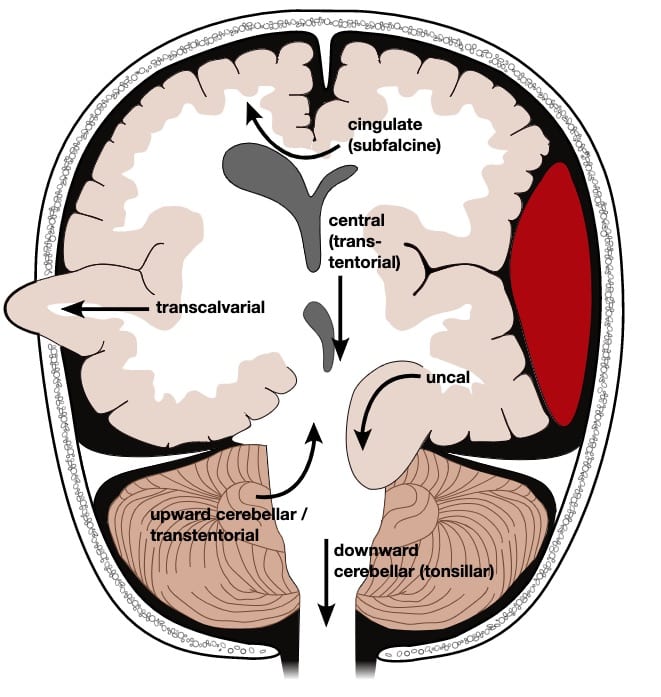 Brain Herniation LITFL CCC Neurology