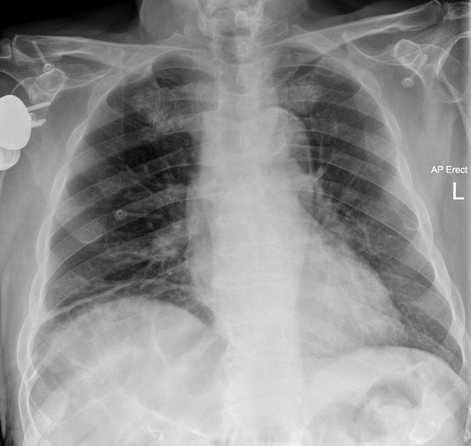 Chilaiditi syndrome • LITFL • Medical Eponym Library