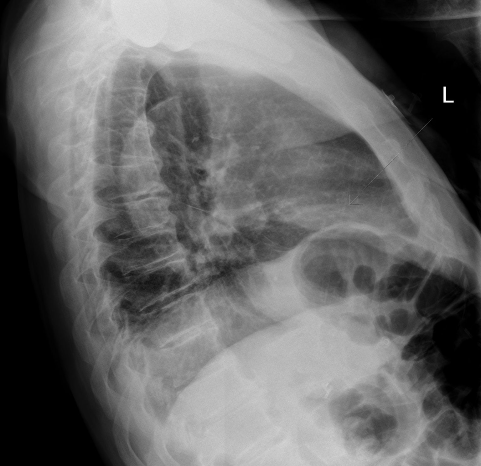 Chilaiditi syndrome • LITFL • Medical Eponym Library