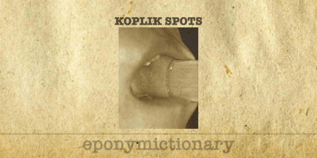Koplik Spots • LITFL Medical Blog • Medical Eponym Library