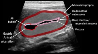 Ultrasound Case 062 • LITFL • POCUS Self-Assessment Quiz