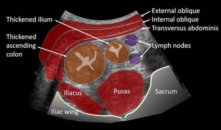 Ultrasound Case 064 • LITFL • POCUS Self-Assessment Quiz