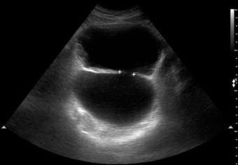 Ultrasound Case 072 • LITFL • POCUS Self-Assessment Quiz