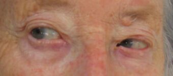 Look left, look right • LITFL • Neurological Mind-Boggler