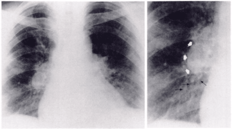Palla sign • LITFL • Medical Eponym Library