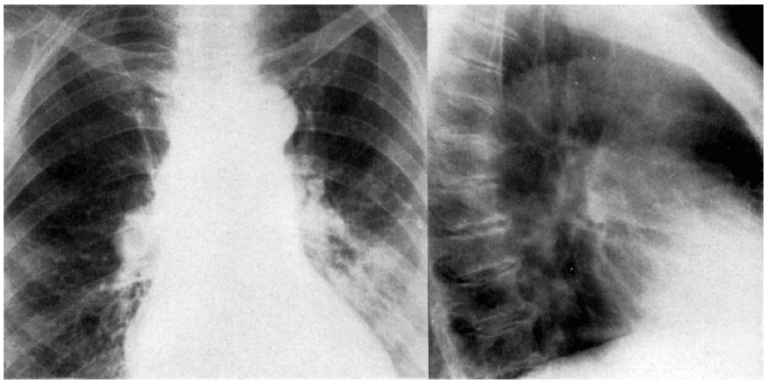 Westermark sign • LITFL • Medical Eponym Library