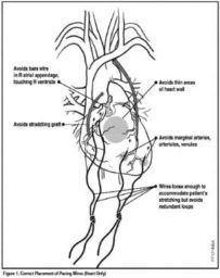 Temporary Epicardial Cardiac Pacing • LITFL • CCC Equipment