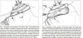 Bag-Valve-Mask (BVM) Ventilation • LITFL • CCC Airway