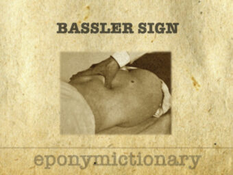 appendicitis larvata Archives • LITFL