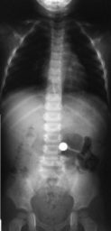 Button Battery Update 3.0 • LITFL • Toxicology Library